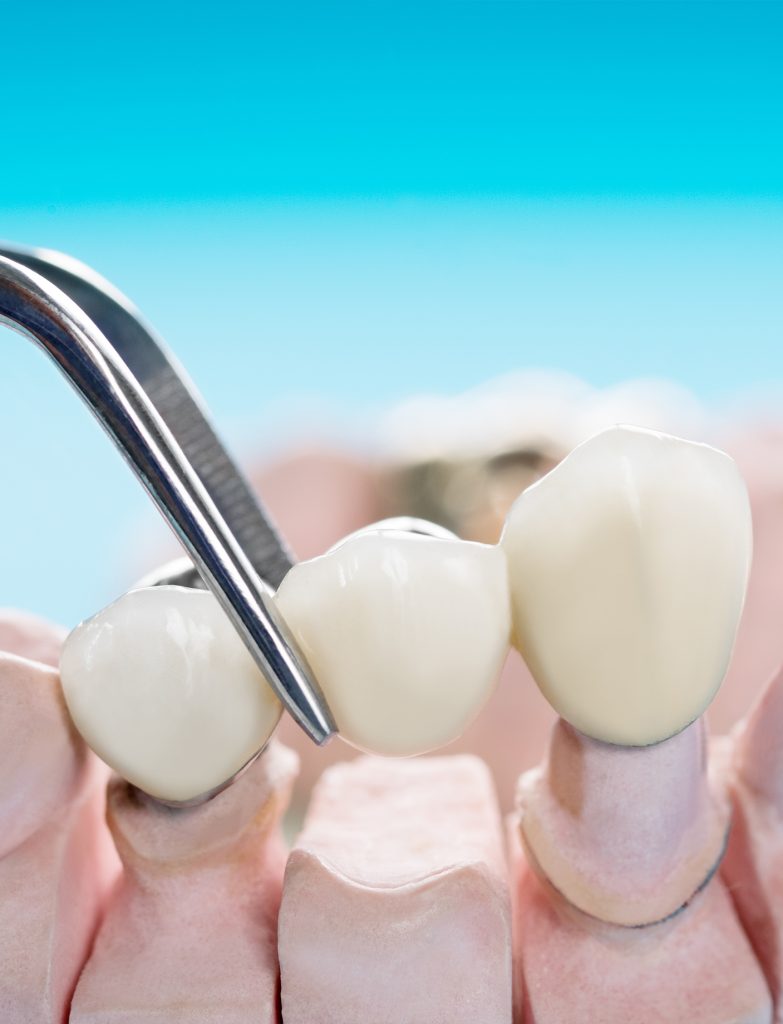 Ponts et prothèses sur implants | Clinique Alain Cyr